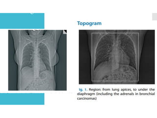 CT SCAN THORAX.pdf