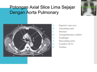 CT SCAN THORAX.pdf