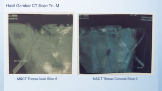 ppt aplikasi klinis Ct-scan thorax pada kasus Corpus Alienum | PPTX