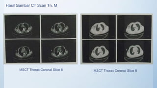 ppt aplikasi klinis Ct-scan thorax pada kasus Corpus Alienum | PPTX