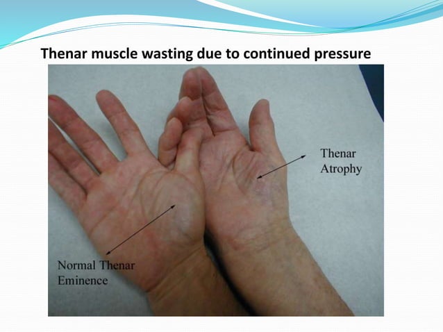Carpal Tunnel Syndrome and Dupuytren's contracture | PPT