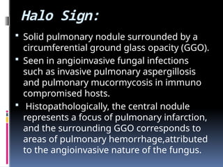 CT SIGNS IN CHESt for pulmonary medicine | PPTX