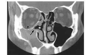 CT sinus cases - cases series of sinus CT | PPTX