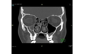 CT sinus cases - cases series of sinus CT | PPTX