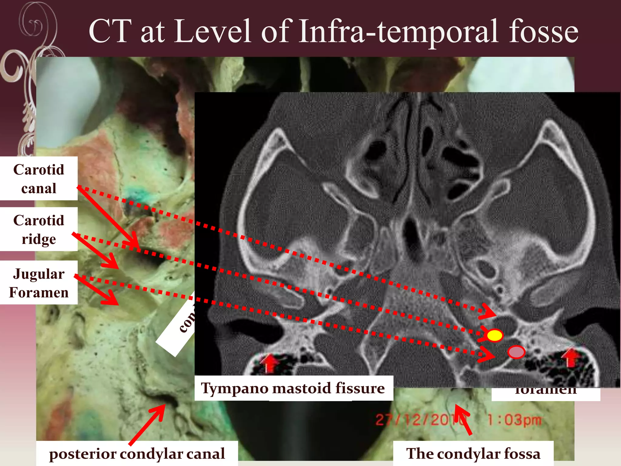 Ct skull base | PPTX