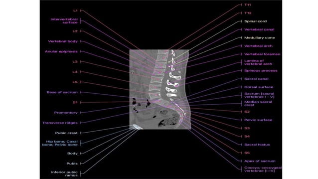 CT SCAN spine | PPTX | Death, Injury, or Military Conflict | Sensitive ...