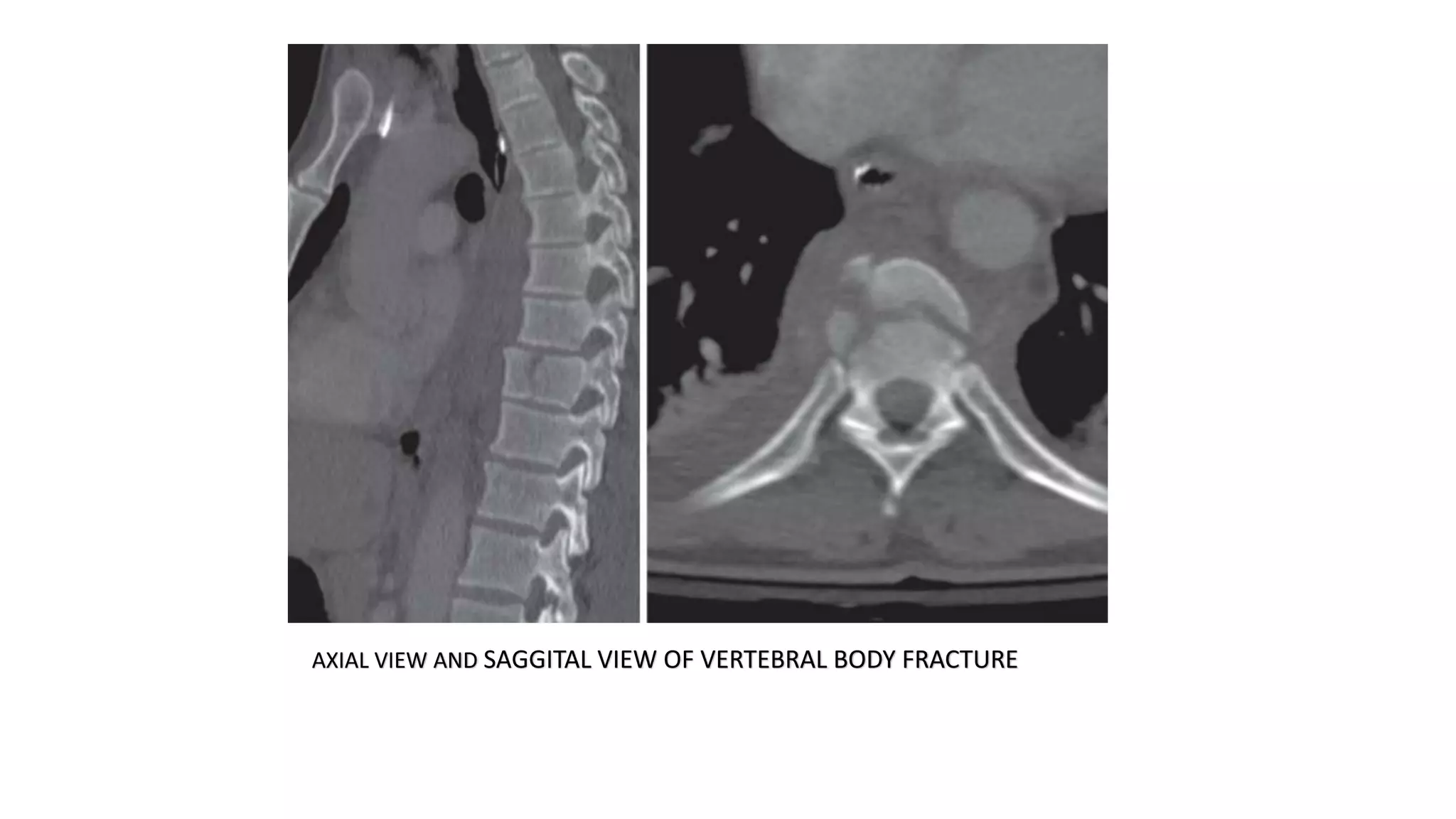 Ct spine fractures ppt | PPT