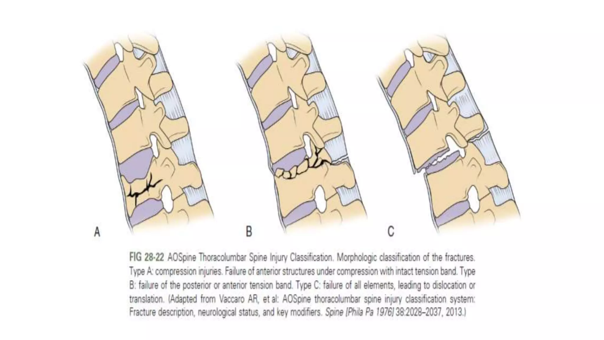 Ct spine fractures ppt | PPT