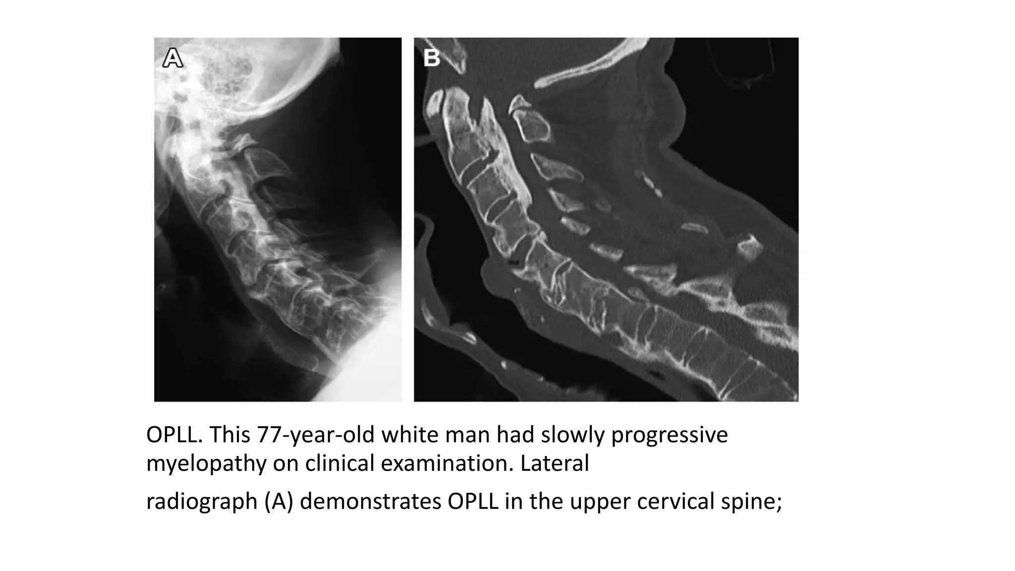Ct spine fractures ppt | PPT