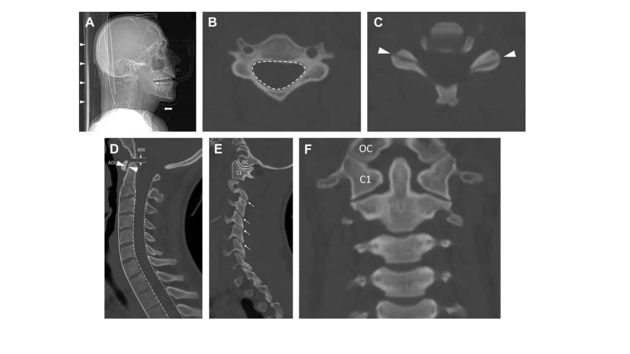 Ct spine fractures ppt | PPT