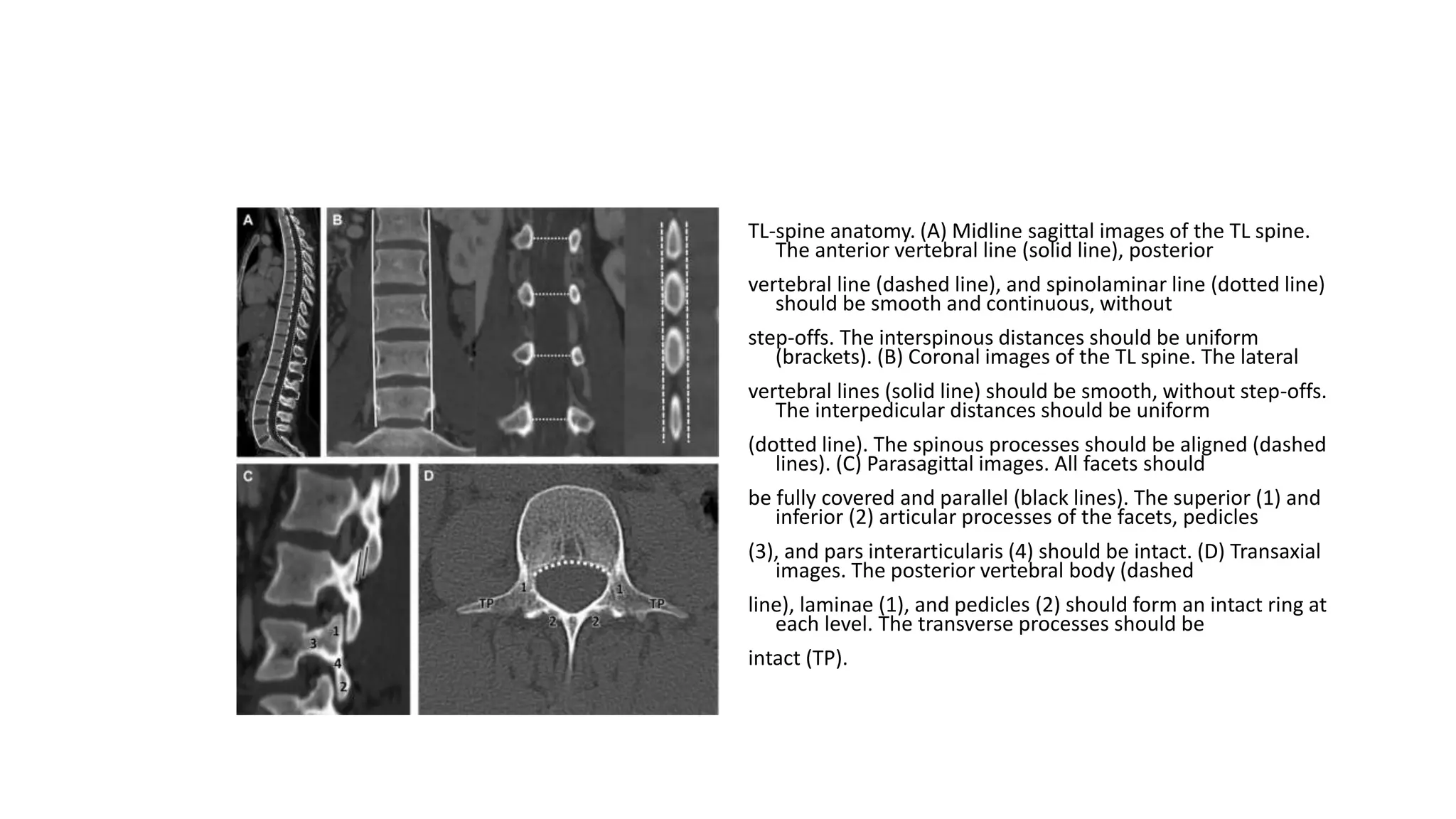 Ct spine fractures ppt | PPT