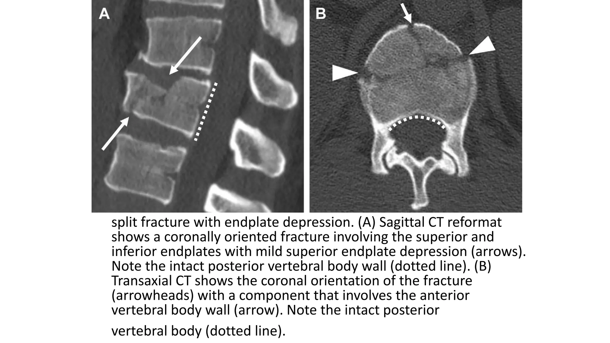 Ct spine fractures ppt | PPT