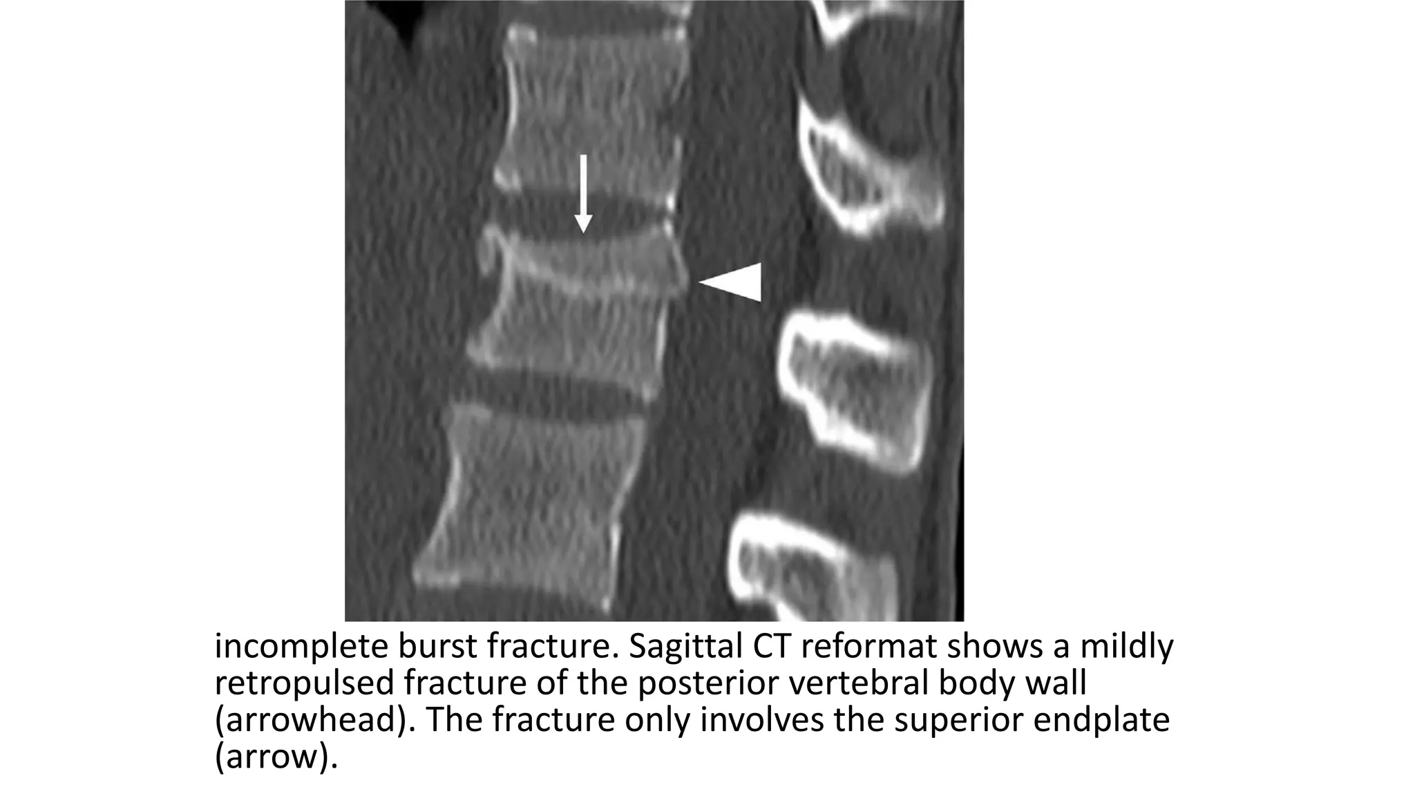 Ct spine fractures ppt | PPT