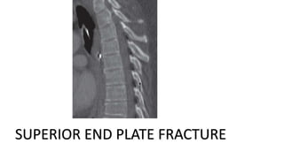 Ct spine fractures ppt | PPT