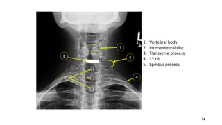 radiological anatomy of the spine S3 applied medical science | PDF