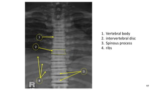 radiological anatomy of the spine S3 applied medical science | PDF