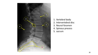 radiological anatomy of the spine S3 applied medical science | PDF