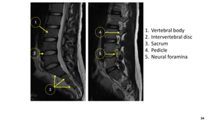 radiological anatomy of the spine S3 applied medical science | PPT