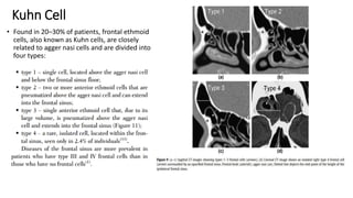 CT SPN dengan penjelasan secara anatomi.pdf