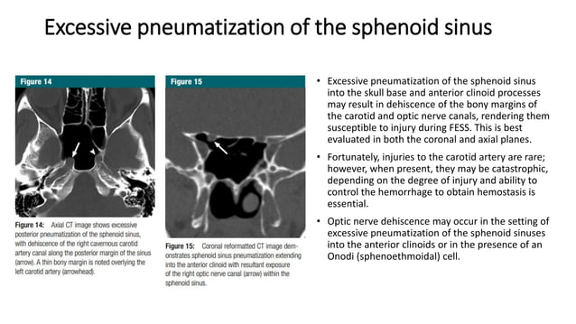 CT SPN dengan penjelasan secara anatomi.pdf