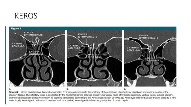 CT SPN dengan penjelasan secara anatomi.pdf