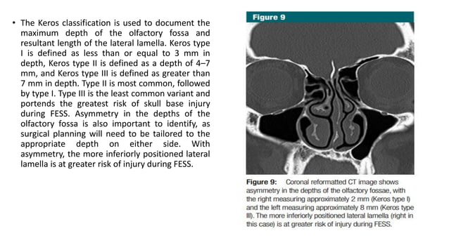CT SPN dengan penjelasan secara anatomi.pdf