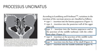 CT SPN dengan penjelasan secara anatomi.pdf