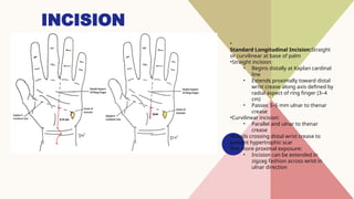 Carpal tunnel syndrome surgical approach.pptx