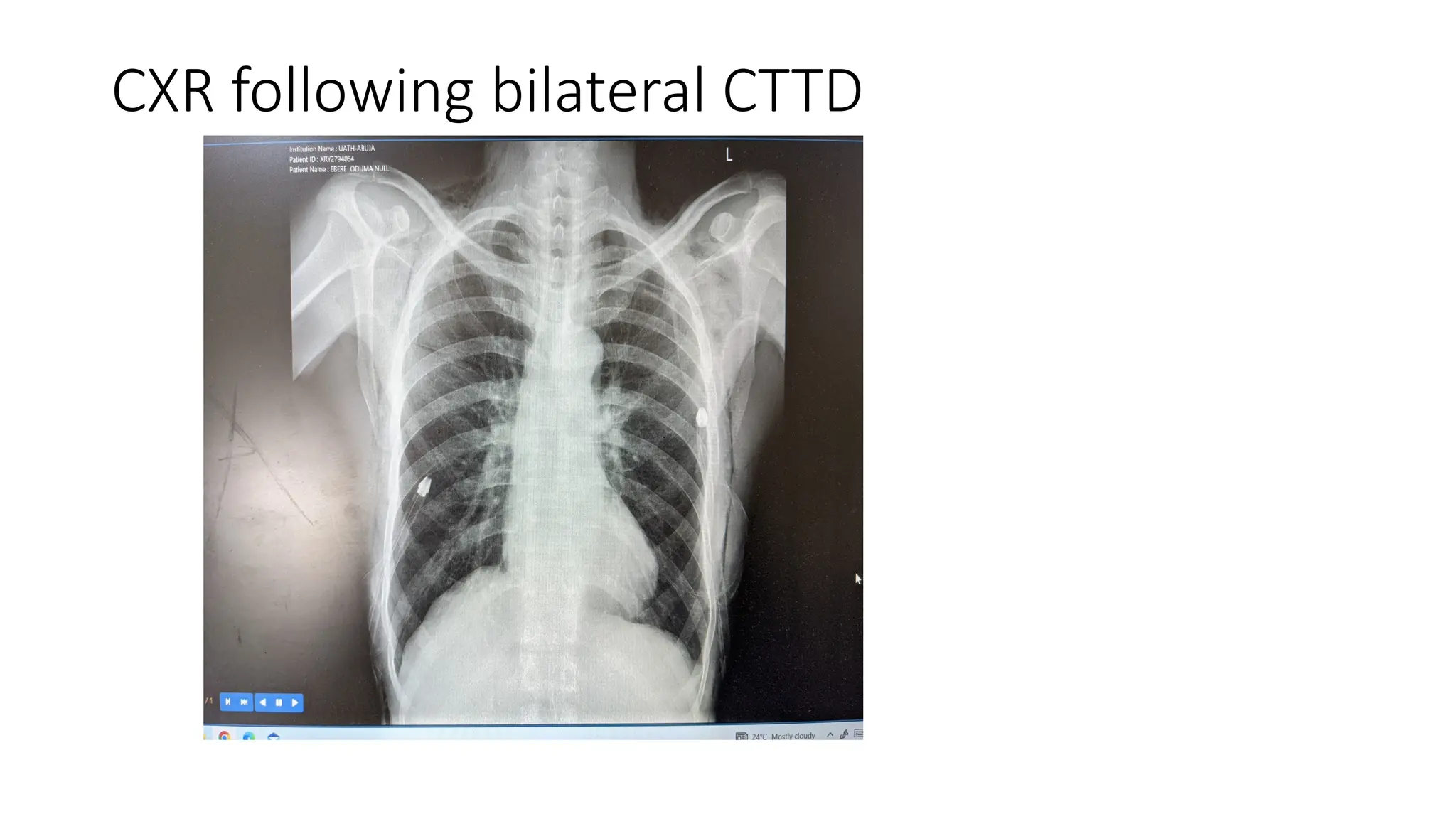 Cardiothoracic surgery discharge summary | PPT