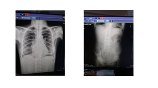 Cardiothoracic surgery discharge summary | PPTX