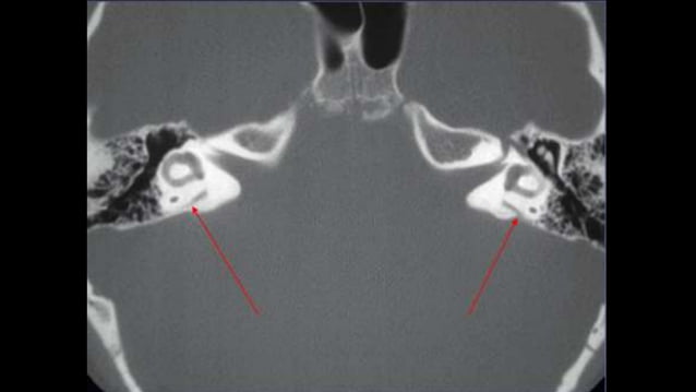 Ct temporal bone | PPTX
