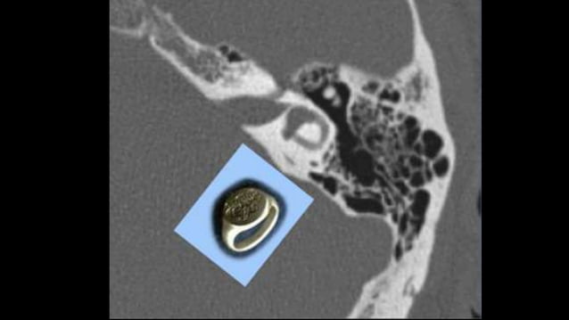 Ct temporal bone | PPTX