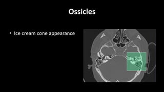 Ct temporal bone | PPTX