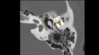 Ct temporal bone | PPTX