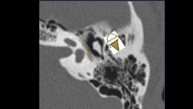 Ct temporal bone | PPTX