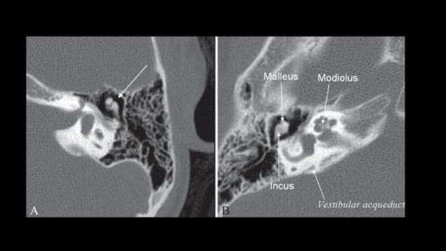 Ct temporal bone | PPTX