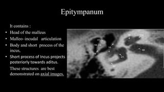 Ct temporal bone | PPTX