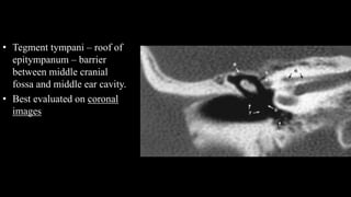 Ct temporal bone | PPTX
