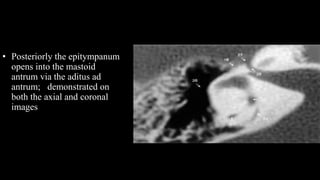 Ct temporal bone | PPTX