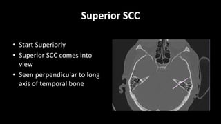 Ct temporal bone | PPTX