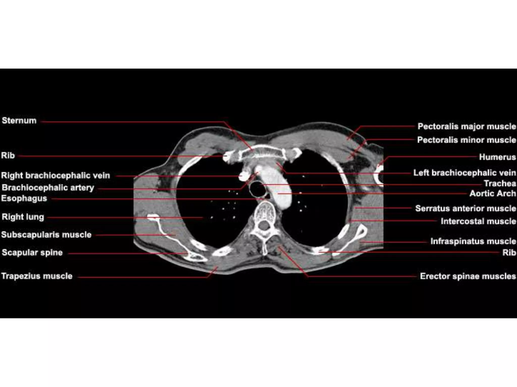 CT Thorax Soft Tissue Axial.pptx