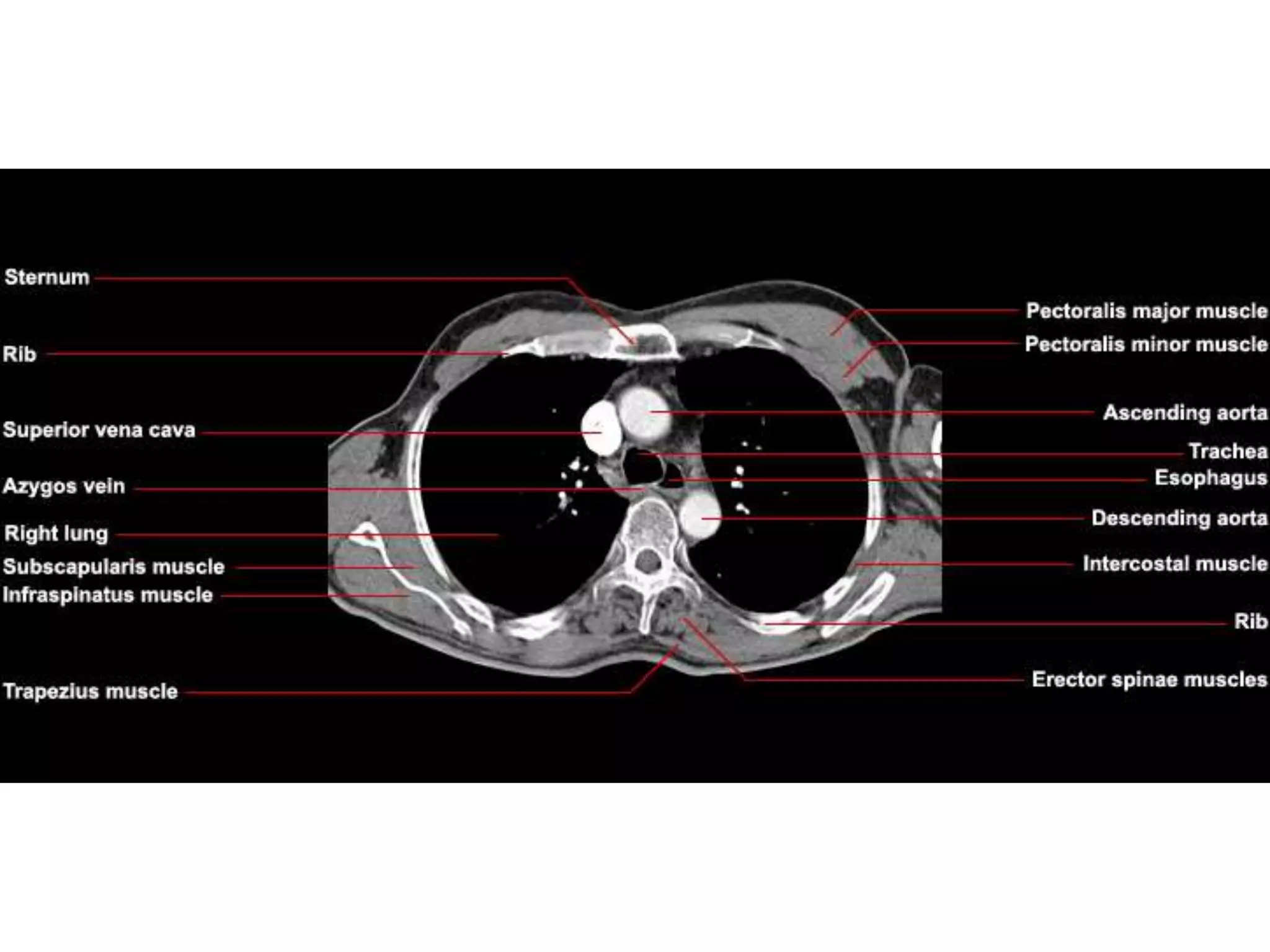 CT Thorax Soft Tissue Axial.pptx