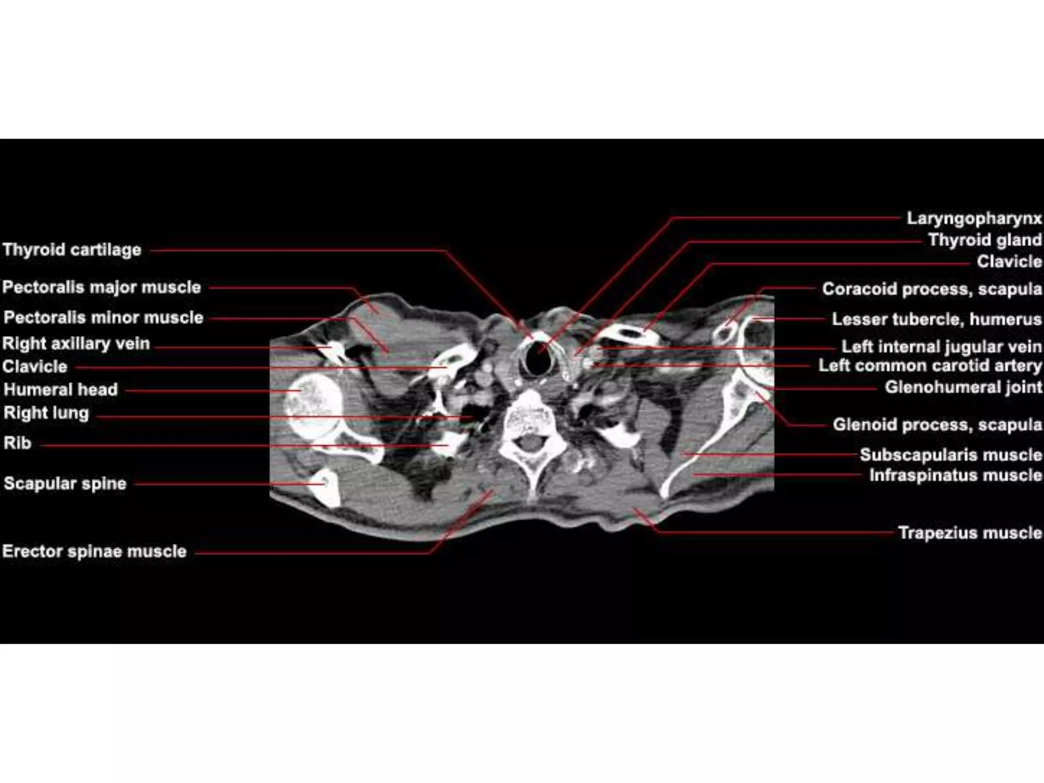 CT Thorax Soft Tissue Axial.pptx