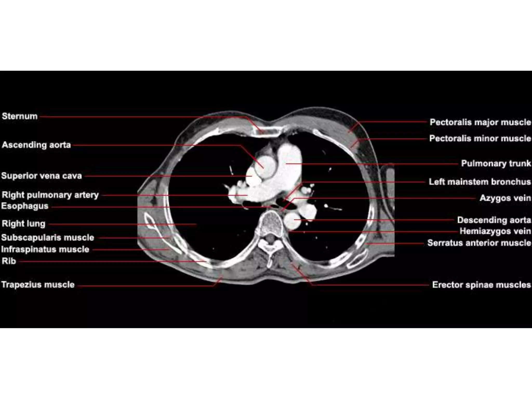 CT Thorax Soft Tissue Axial.pptx