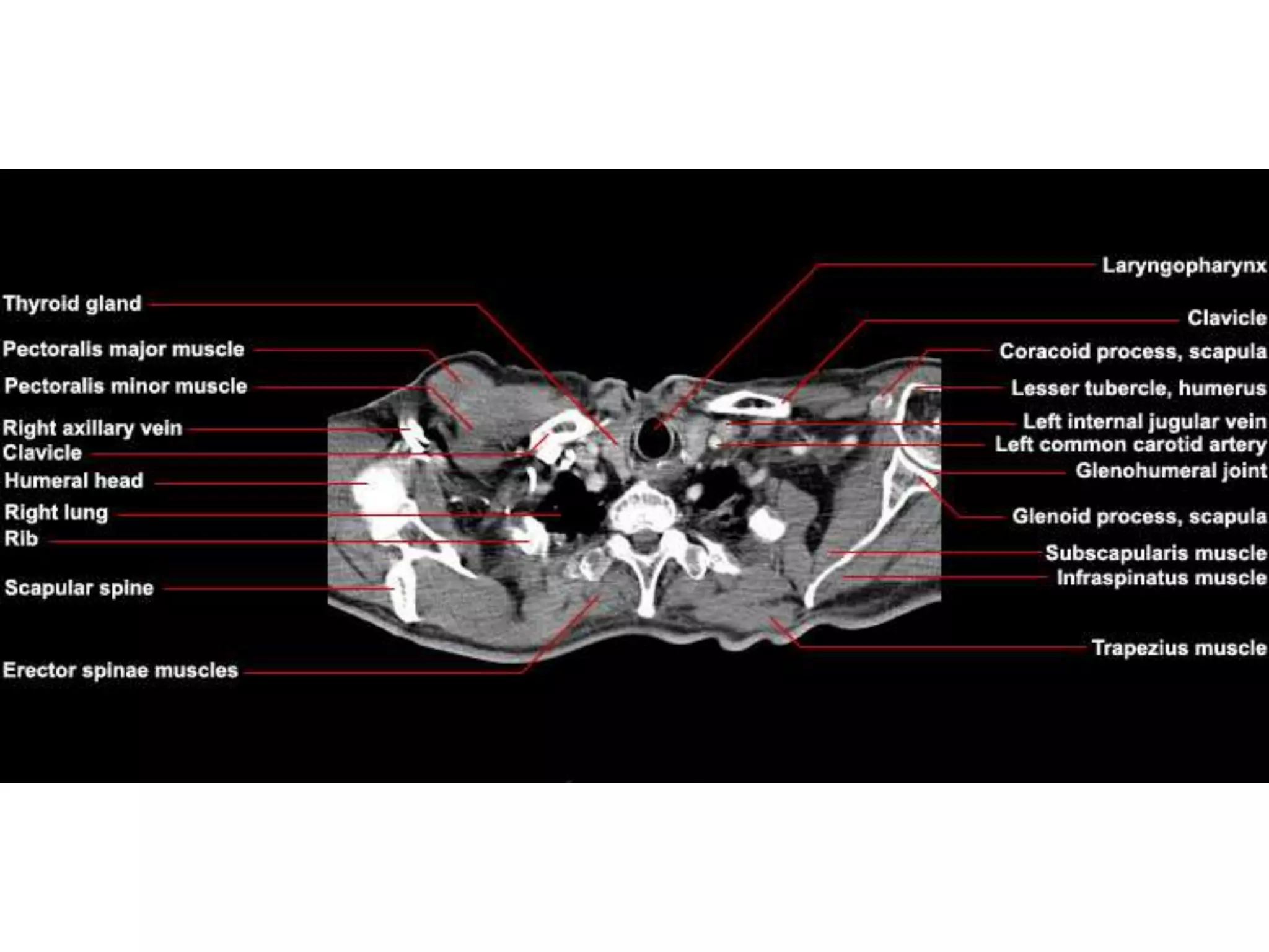 CT Thorax Soft Tissue Axial.pptx