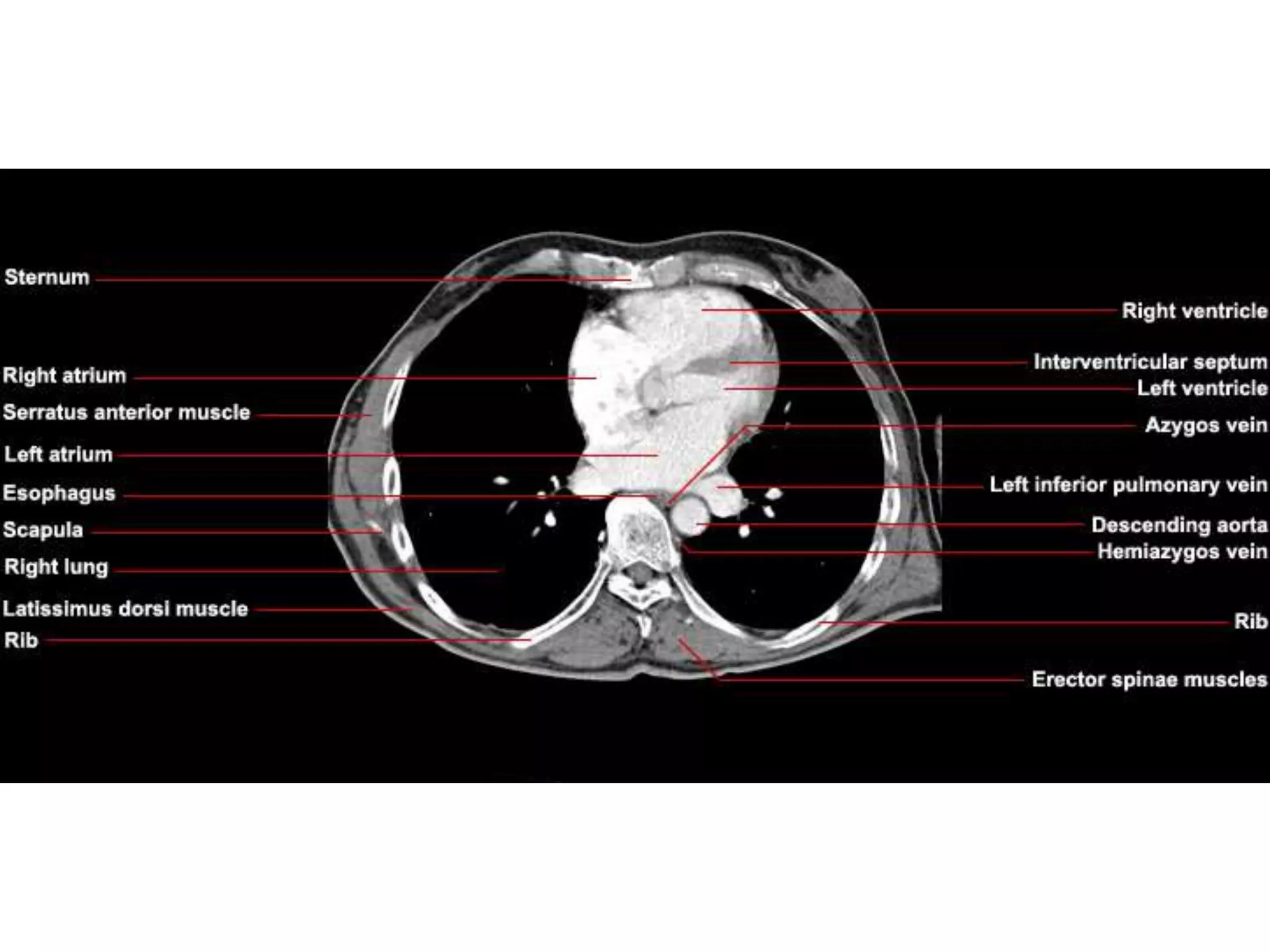 CT Thorax Soft Tissue Axial.pptx