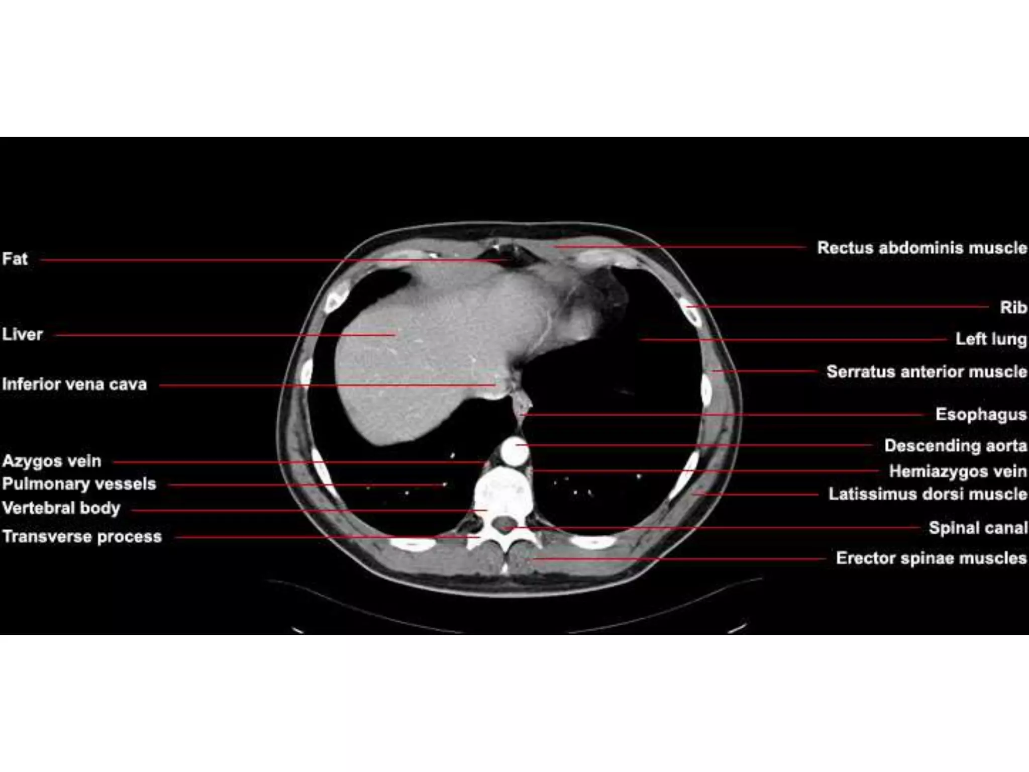 CT Thorax Soft Tissue Axial.pptx