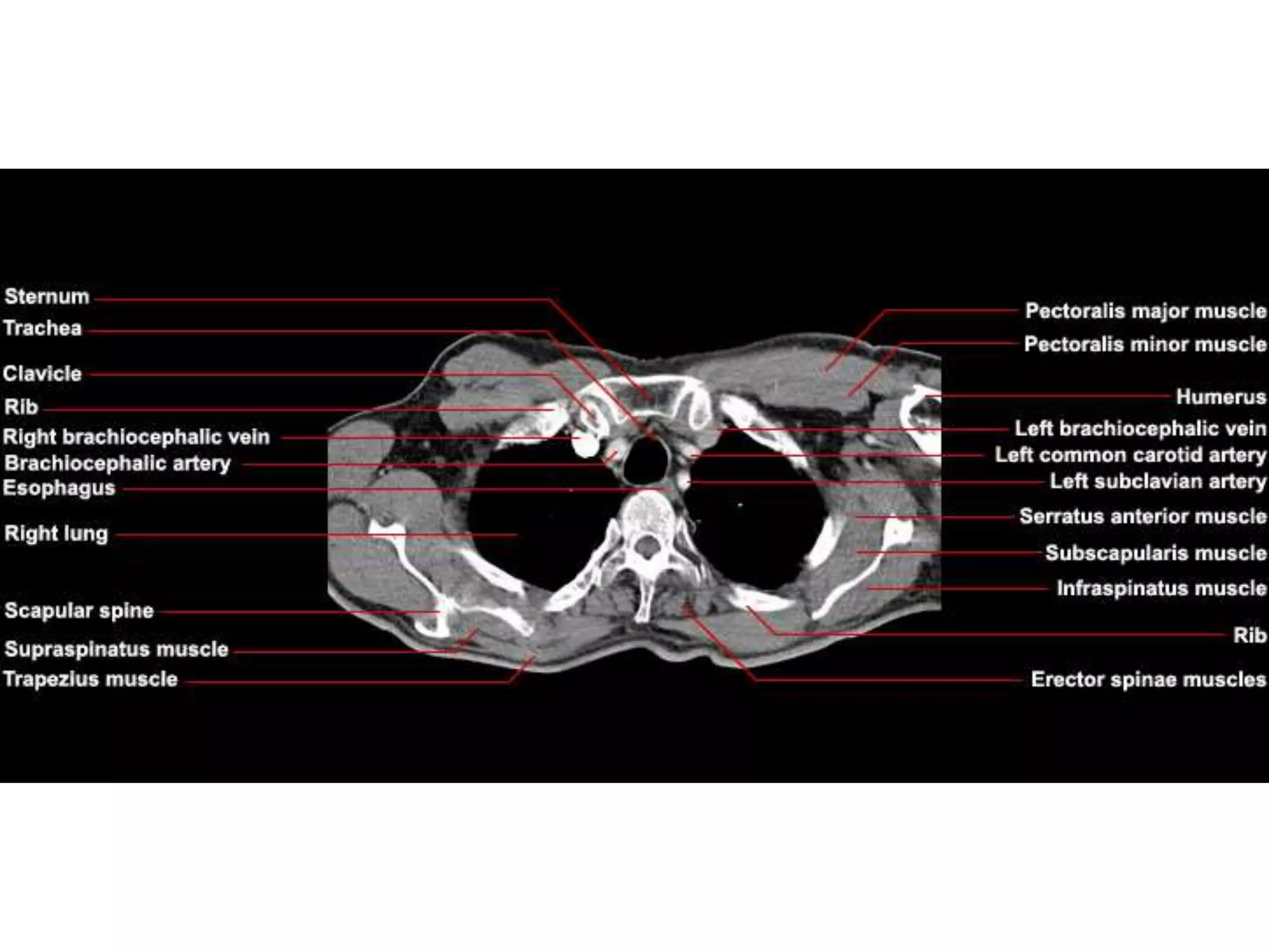CT Thorax Soft Tissue Axial.pptx