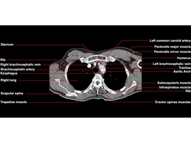 CT Thorax Soft Tissue Axial.pptx