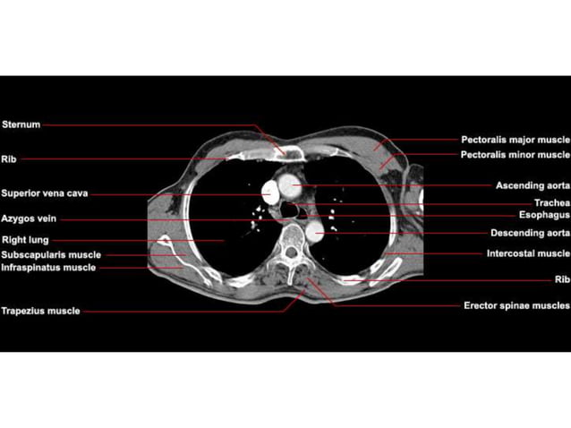 CT Thorax Soft Tissue Axial.pptx